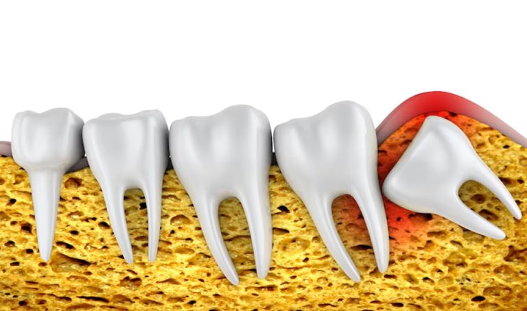 Wisdom Teeth - Innovatedental